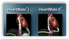 FDA approves new Thoratec heart pump - Medical Quack